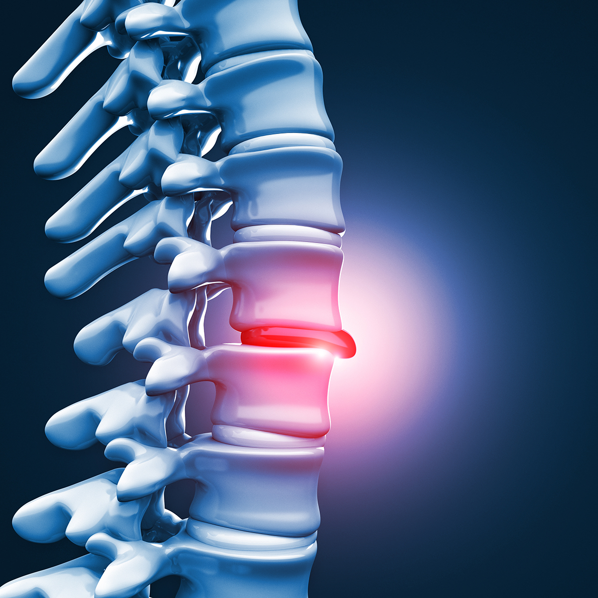 Cervical Disc Replacement Edison Spine Center